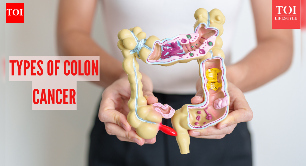Colon Cancer Symptoms: 4 types of Colon Cancer: Symptoms, causes, and ...