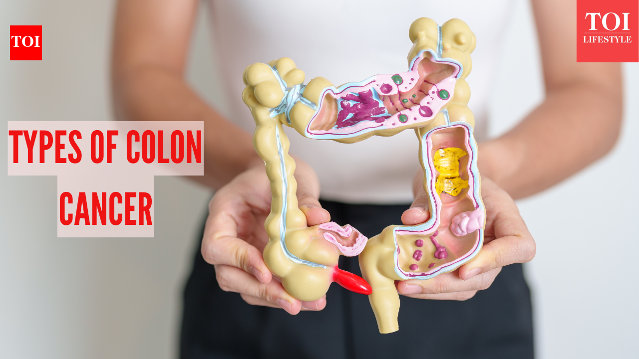Colon Cancer Symptoms: 4 types of Colon Cancer: Symptoms, causes, and ...