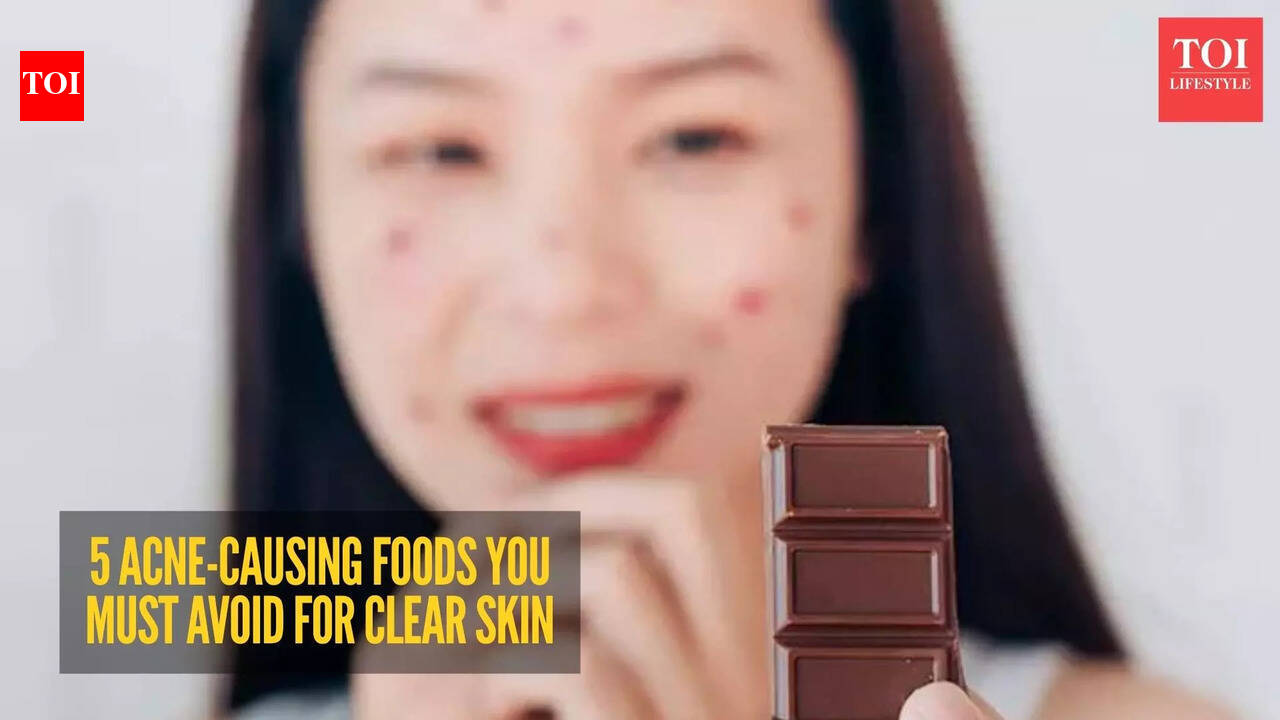 5 everyday foods responsible for triggering acne and breakouts