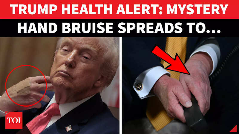 On Cam: Trump INJURED, Mystery Bruise 'Spreads' As Health Panic Rocks ...