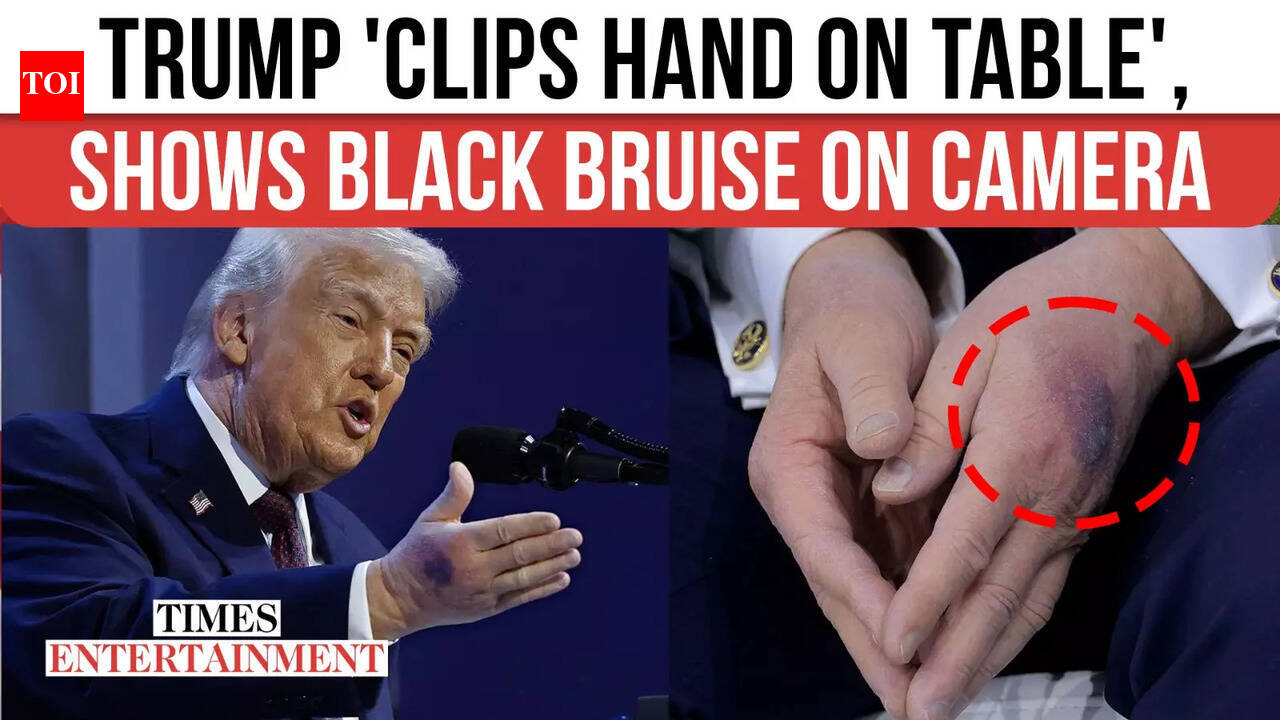Trump Shrugs Off Fresh Hand Bruise After Davos Appearance Reignites ...
