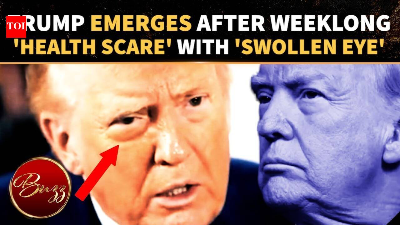 Trump STUNS Viewers With 'SWOLLEN EYE' On 'Pod Force One' After Going ...