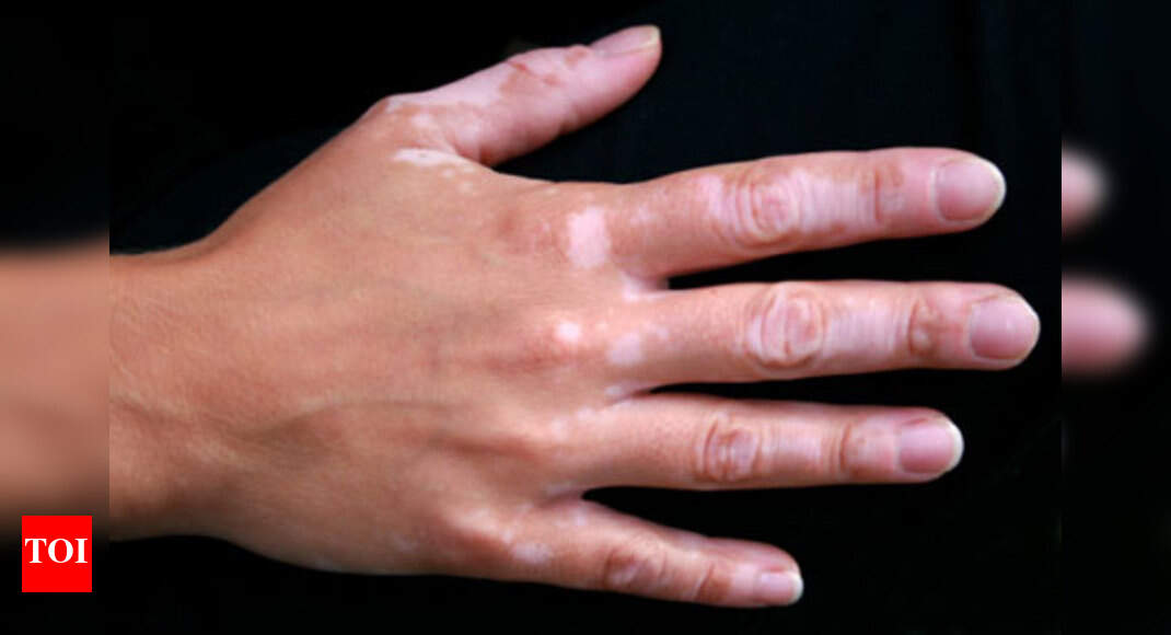 All you need to know about Vitiligo - Times of India