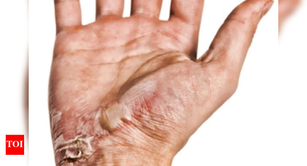 How to care for basic burns - Times of India