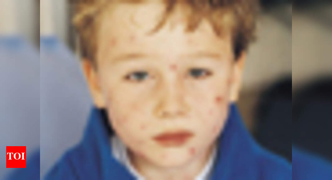 Smallpox affects human immune system - Times of India