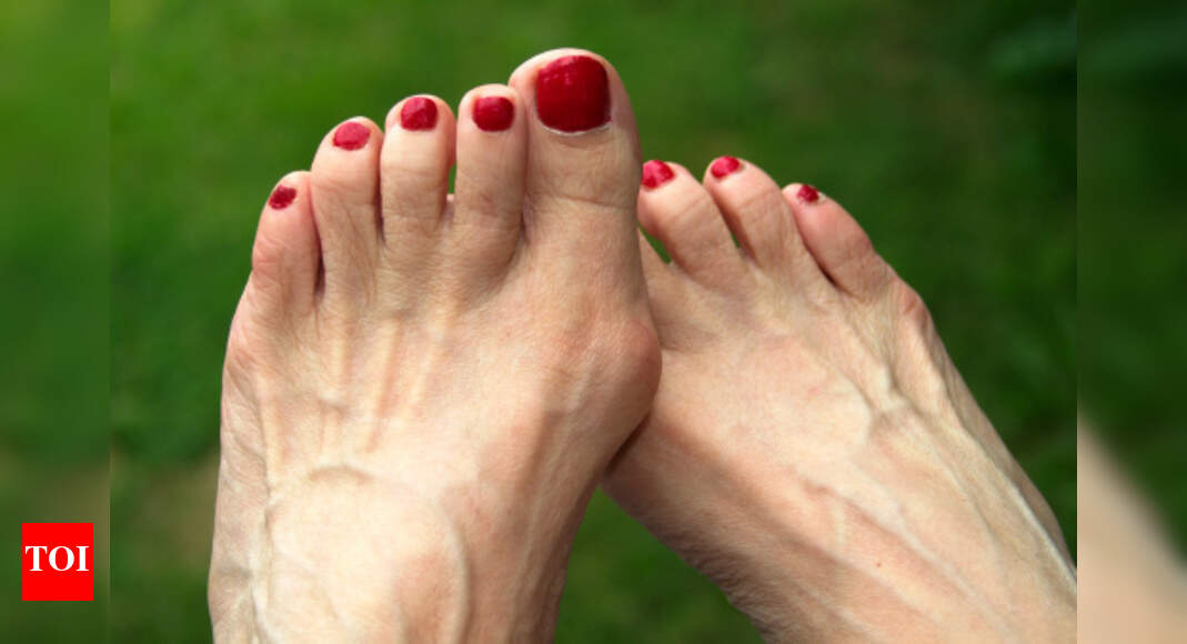 What are bunions? Symptoms and how to treat them? - Times of India