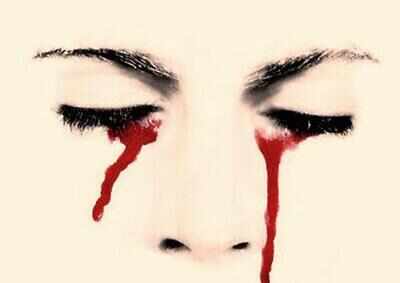 Girl on recovery road after 'bloody tears' disease | Kolkata News ...