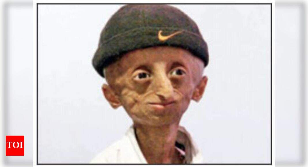 Progeria kid dies at 15 in Telangana | Hyderabad News - Times of India