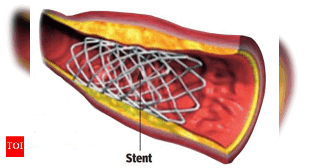 Stents make up only 25% of angioplasty cost: Study | Mumbai News ...