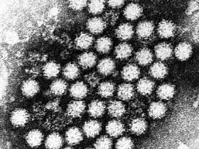 Wild Type 2 poliovirus found in Hyderabad | Hyderabad News - Times of India
