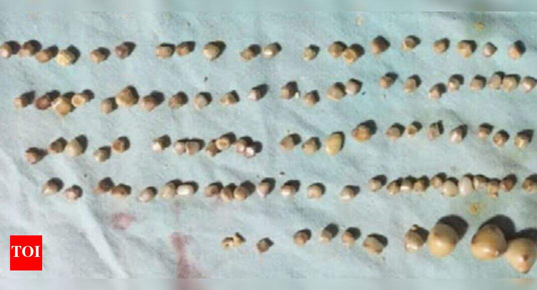 Gallstones From The Gall Bladder: Woman operated, 206 gallstones ...