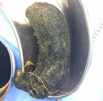 Chennai doctors remove giant hairball from girl’s stomach | Chennai ...