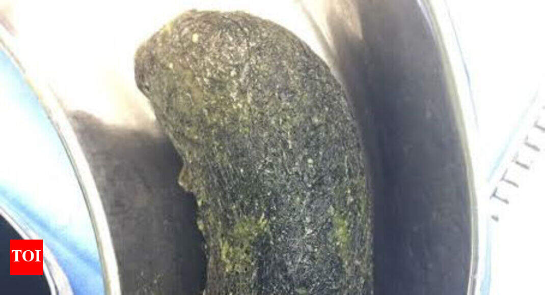 Chennai doctors remove giant hairball from girl’s stomach | Chennai ...