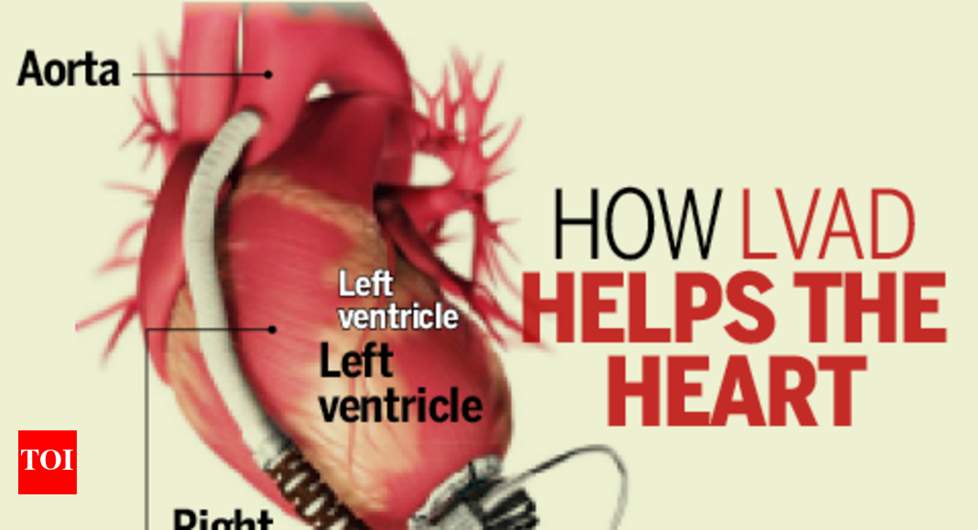 India China News: What is LVAD and how it works | India News - Times of ...