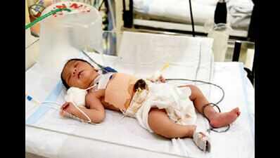 Baby With 4 Legs: Baby with 4 legs, 3 hands undergoes surgery, fine ...