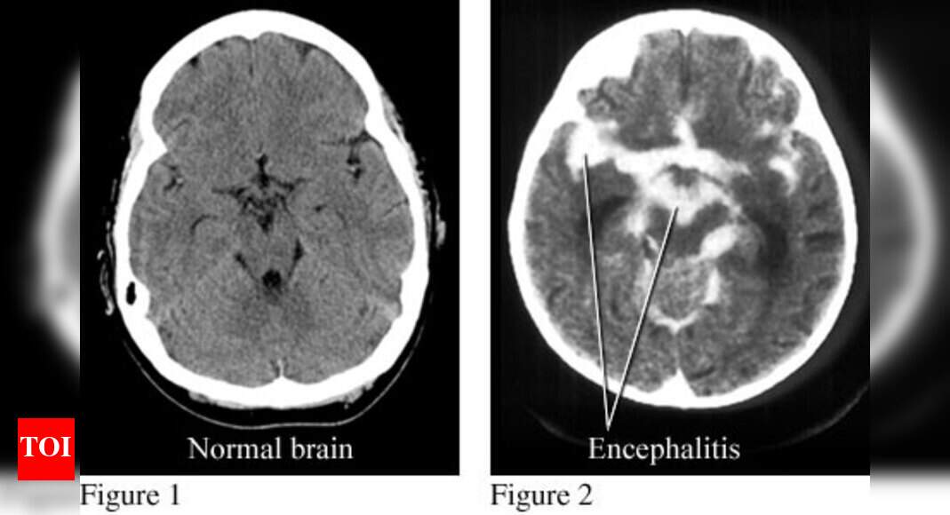 encephalitis virus - Times of India