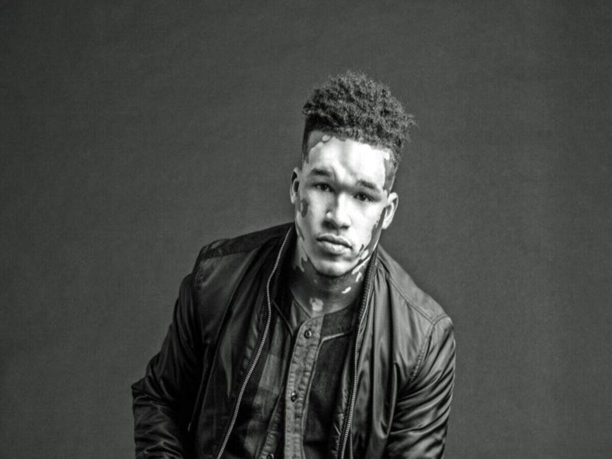 Model with vitiligo redefines what it means to be beautiful