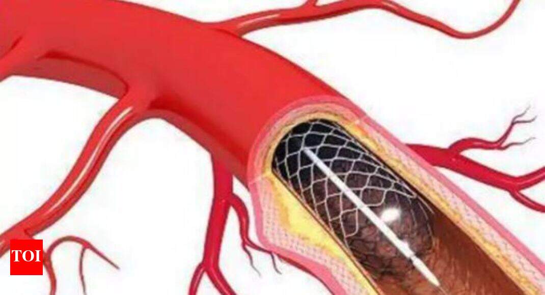 Cardiac stent price cap lowered further to Rs 28,000 | India News ...