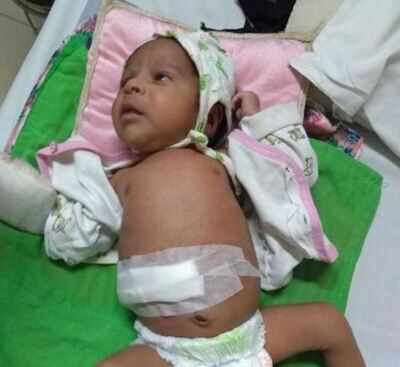 Underdeveloped fetus removed from 20-day-old boy | Ahmedabad News ...