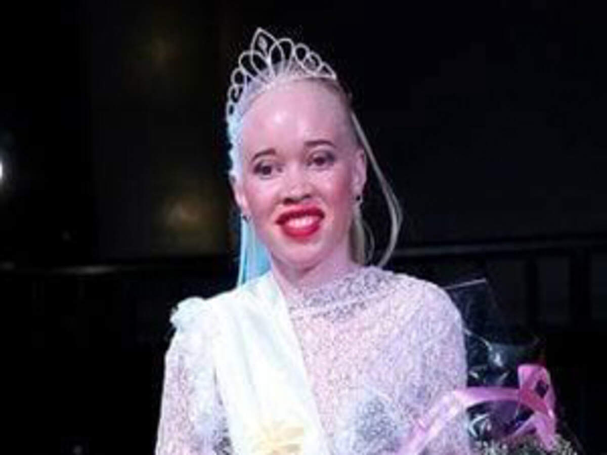 Zimbabwe crowns its first ever Albino beauty queen - Times of India