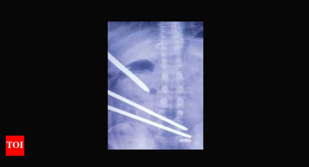 CT Scan: Doctors couldn’t carry out tests because of protruding rods ...