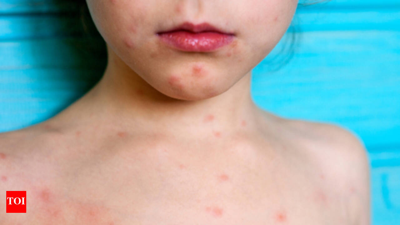 Chicken Pox On Face First