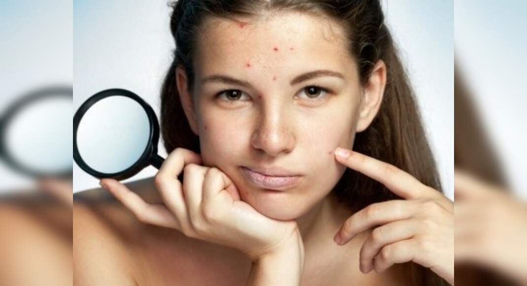 Treating acne problem: Here's why you should treat acne as early as ...