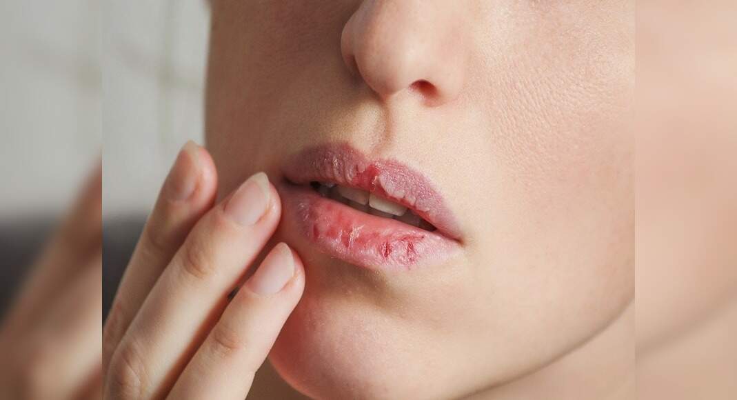 Home remedies for chapped lips :::Misskyra
