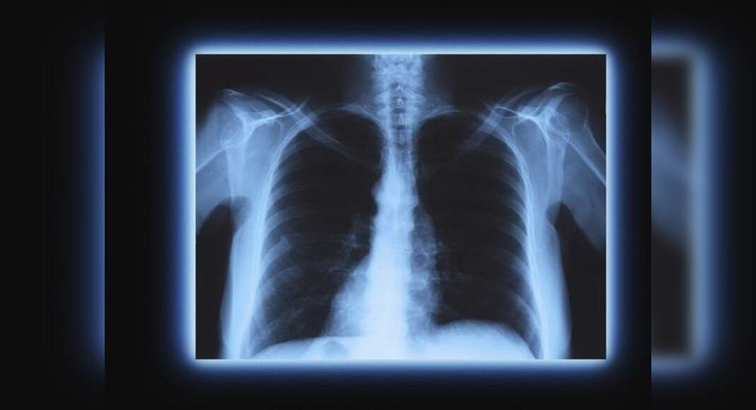 X-ray radiations increases cancer risk for obese people - Misskyra.com