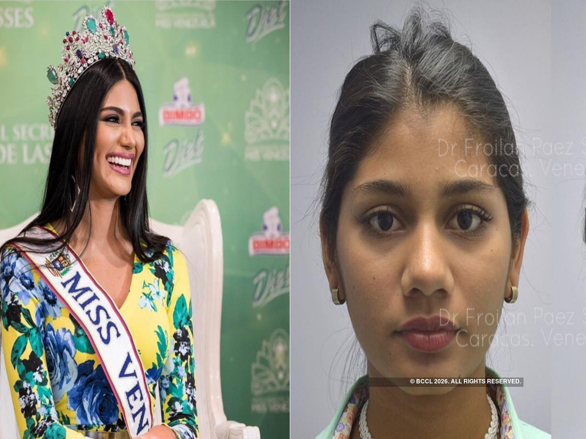 Before and after surgery photos of Miss Universe Venezuela go viral