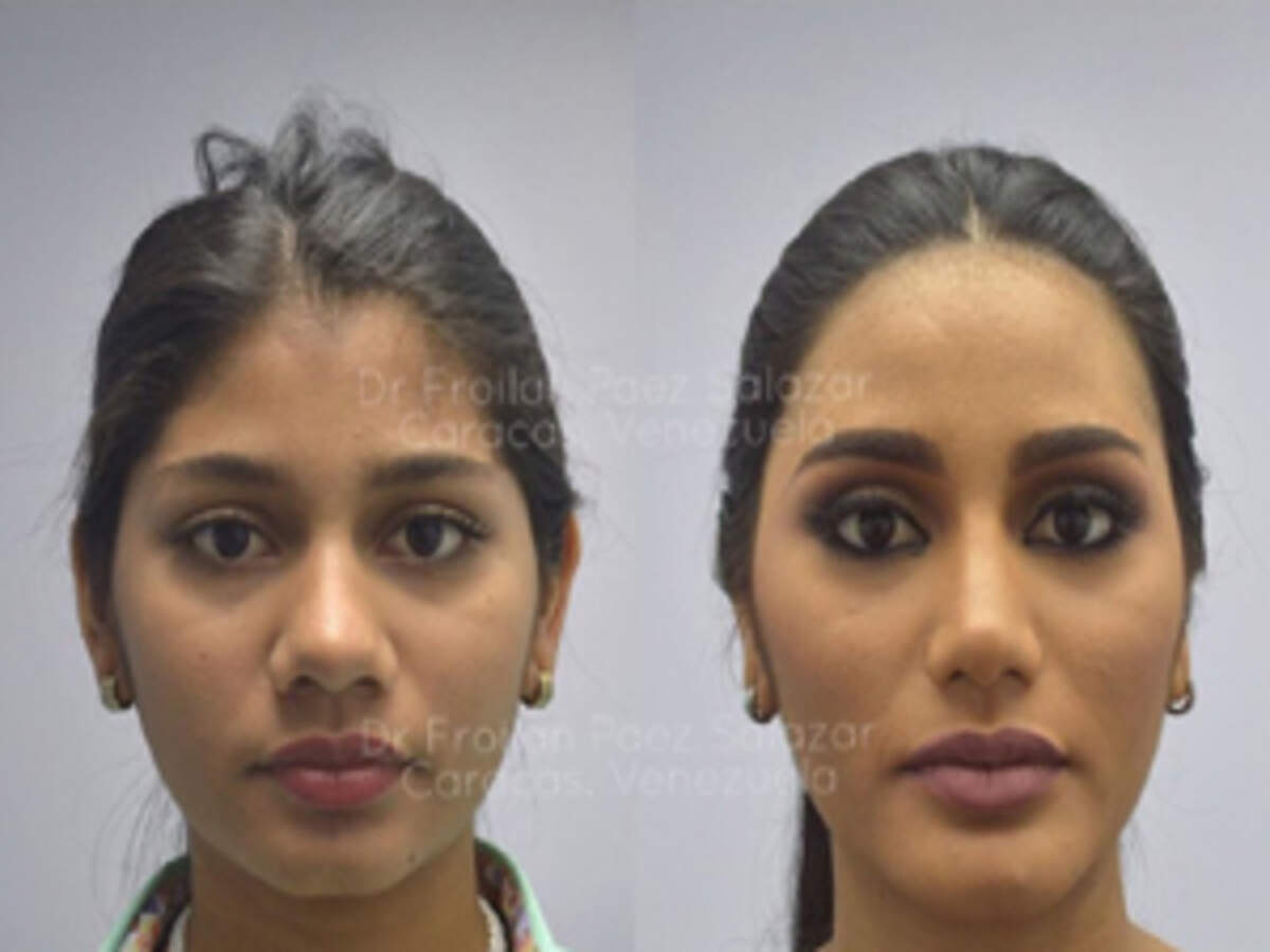 Beauty queen’s plastic surgery pictures shocks the world