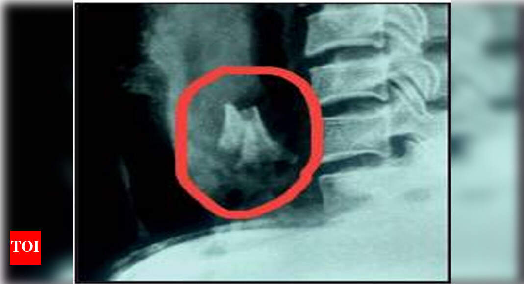 Chicken bone stuck in Karnataka man’s throat taken out after 3 days ...