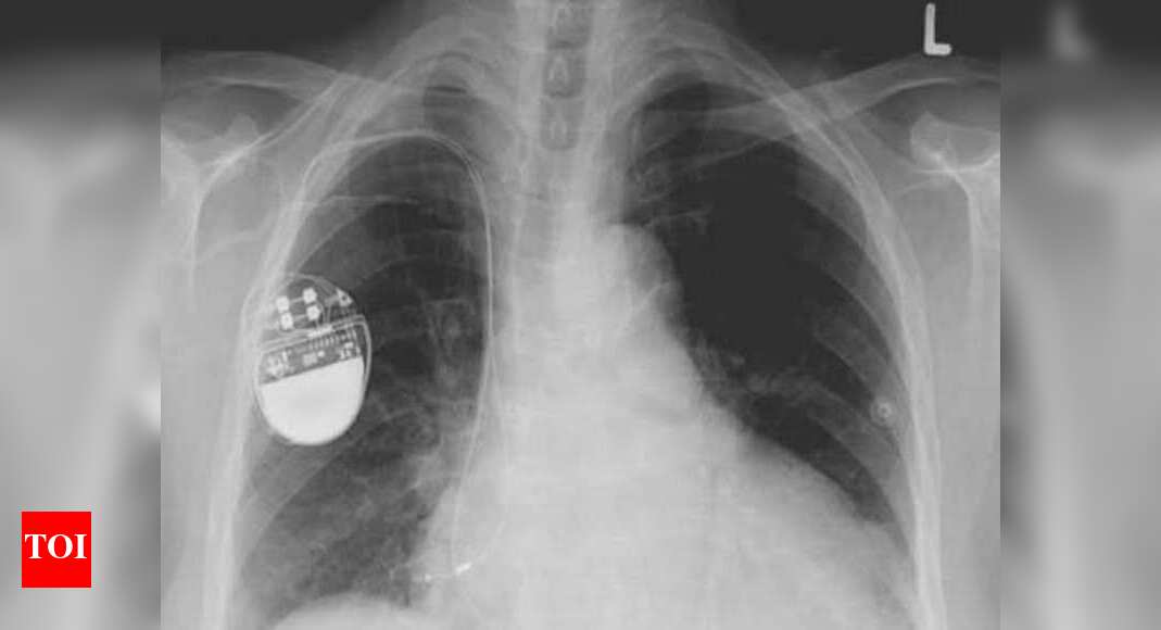 Now, pacemakers that are powered by heartbeats - Times of India