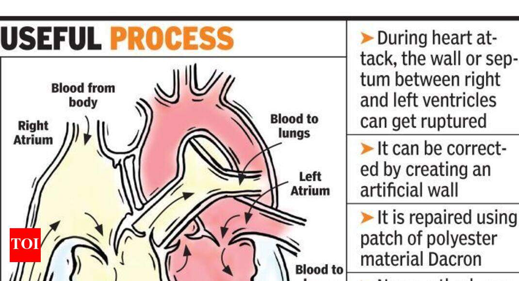 New technique ups survival rate of heart attack patients | Nagpur News ...