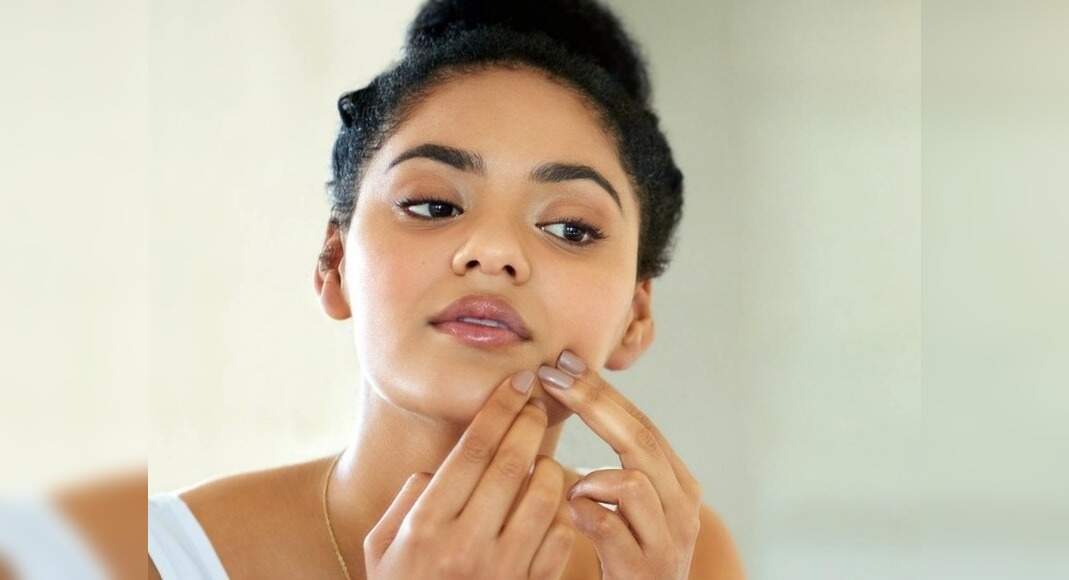 Pimple Patch Benefits You Should Be Aware Of