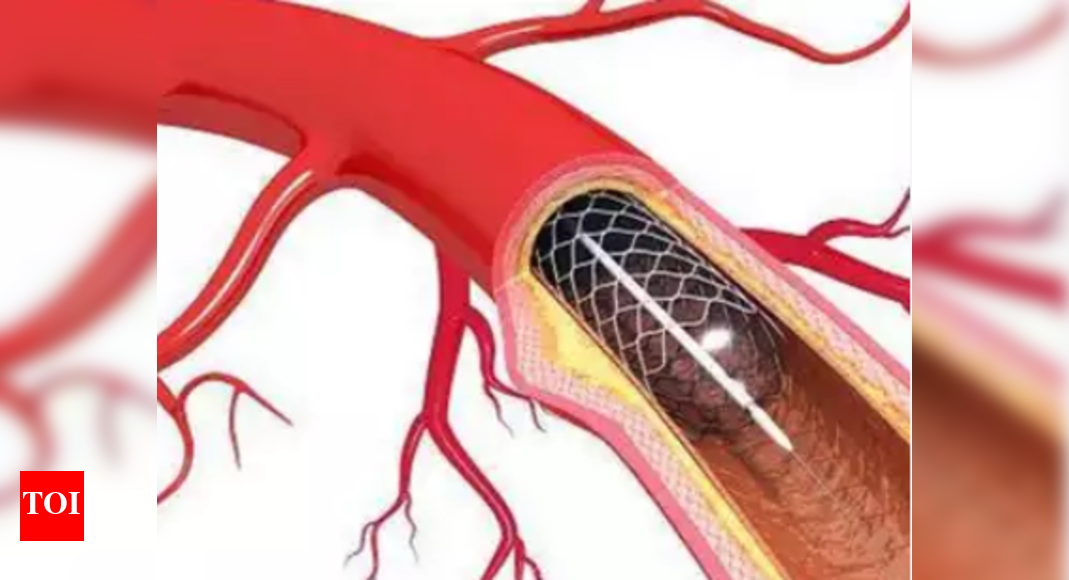 World's smallest stent developed by scientists - Times of India