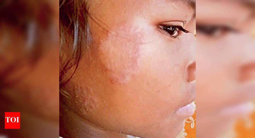 Skin disease scare in residential schools in Visakha tribal area ...