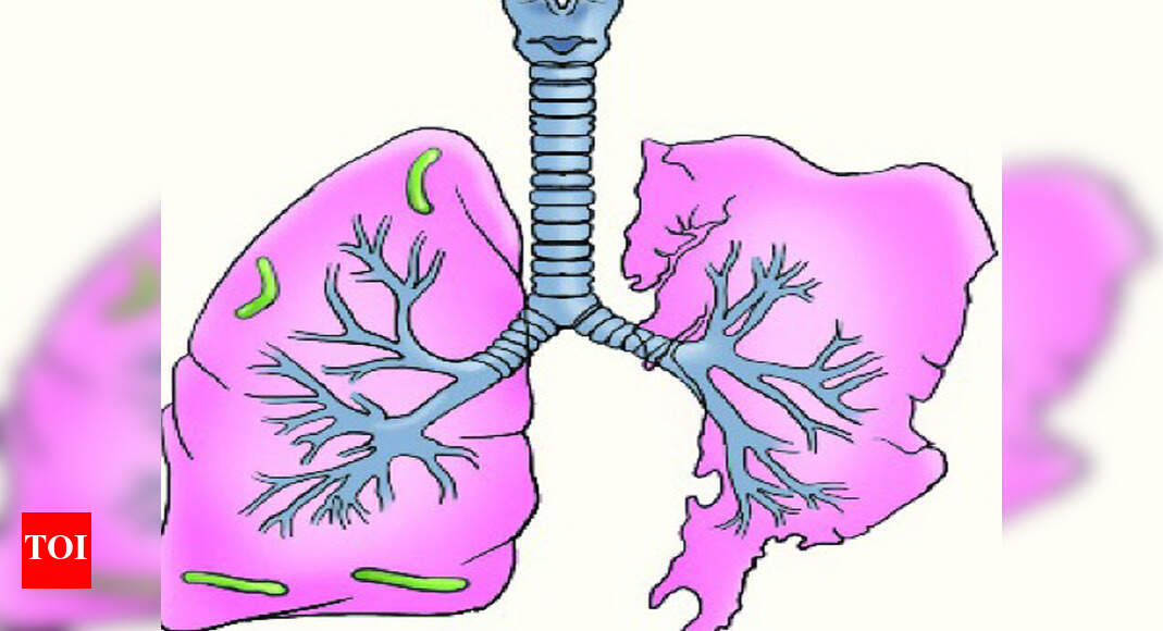 Man gets fresh life after removal of one lung | Kochi News - Times of India