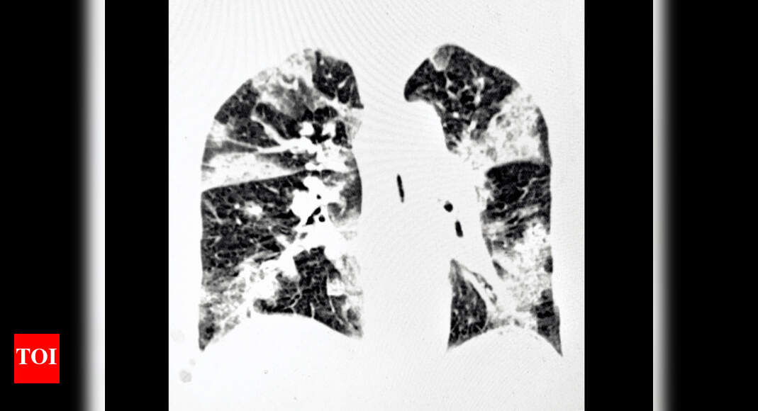 Gujarat Corona Update: Gujarat doctors use CT scan as Covid test, 73 ...