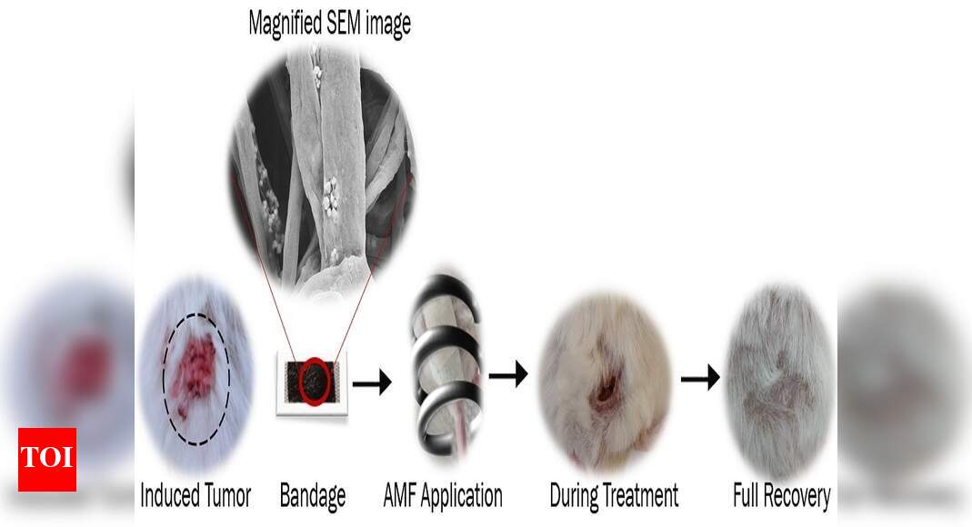 IIsc develops bandage that kills skin cancer cells | India News - Times ...