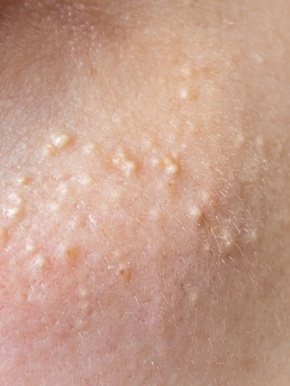White Bumps On Cheeks Don't Mistake These Skin Conditions For Acne