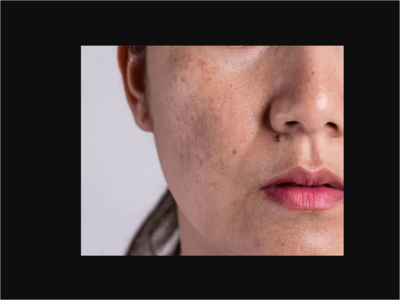 Anti Pigmentation Serum: Get freedom from pigmentation, dark spots ...