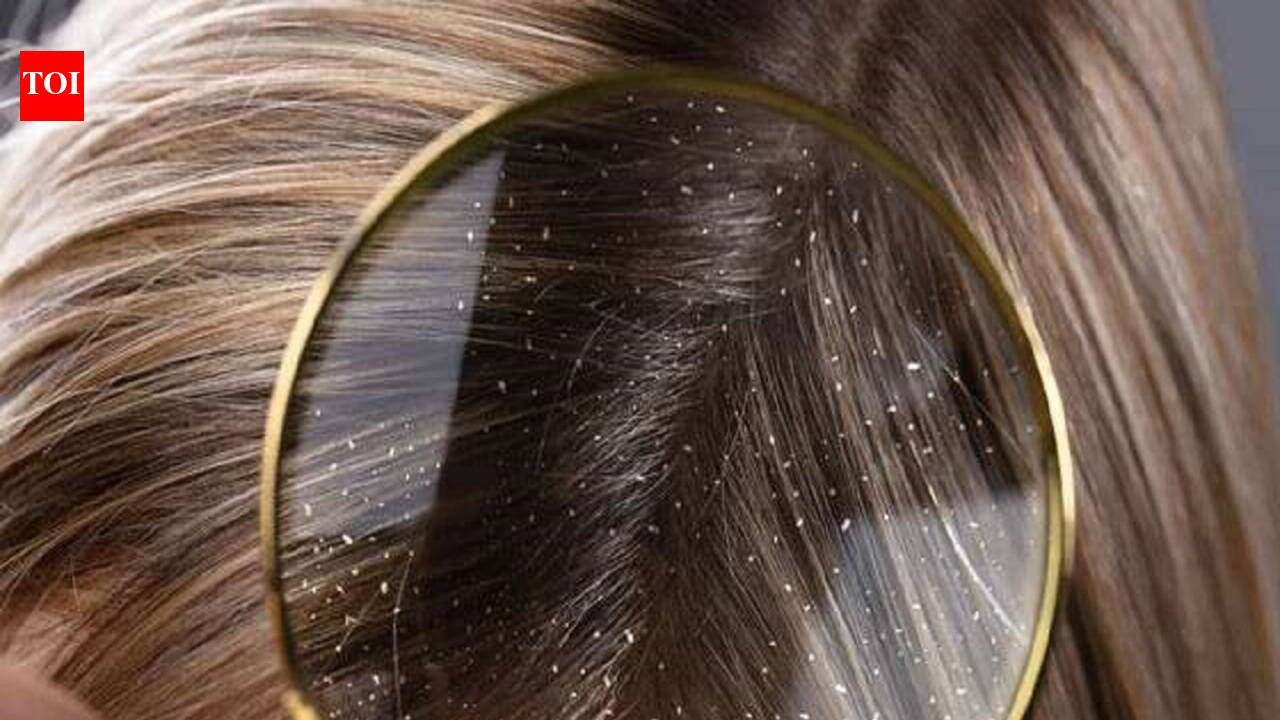 Anti-dandruff conditioner: Say no to flaky, and itchy scalp - The Times ...