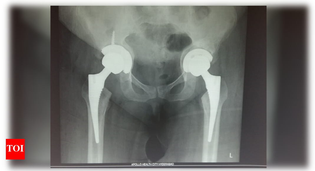 Evolving dynamics in total hip replacement patient care - Times of India