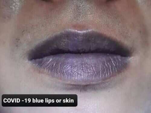 Blue Lips From Lack Of Oxygen | Lipstutorial.org