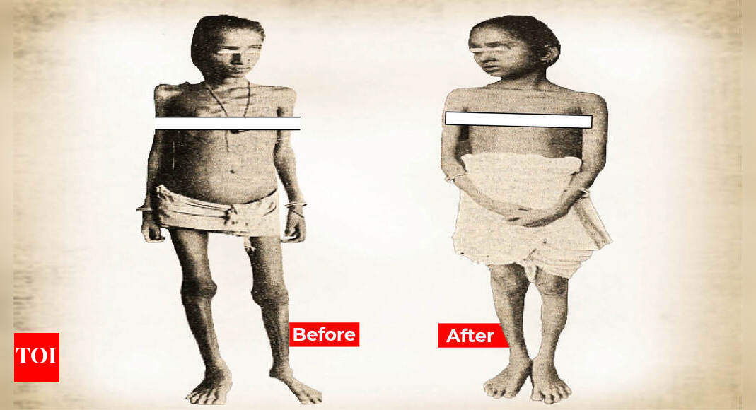 The first child to get insulin in India - Times of India