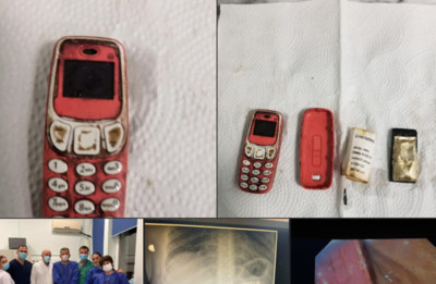 Man swallows phone, undergoes two-hour-long surgery to remove it ...