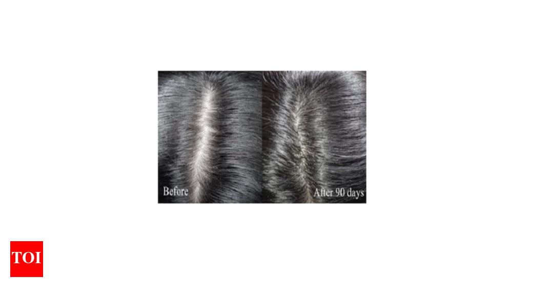 These Tasty Gummies Reduce Hair Fall By 35%, Expert Opinion By Dr ...