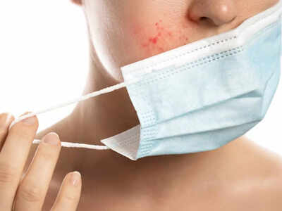Everything you need to know about maskne - Times of India