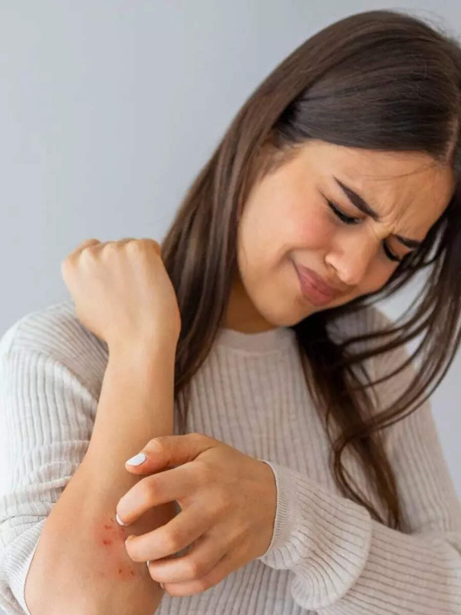 Signs of psoriasis on your skin | Times of India